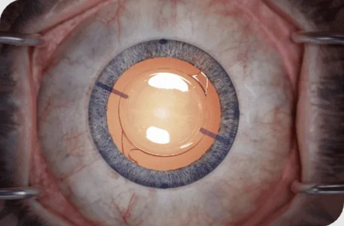 Learning Surgical Skills In A VR “Flight Simulator For Surgeons”